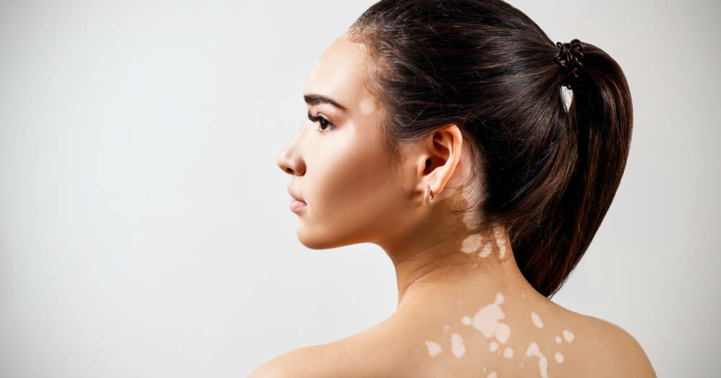 Vitiligo (Pigmentation Disorders) Treatment in Antalya | Antalya ...